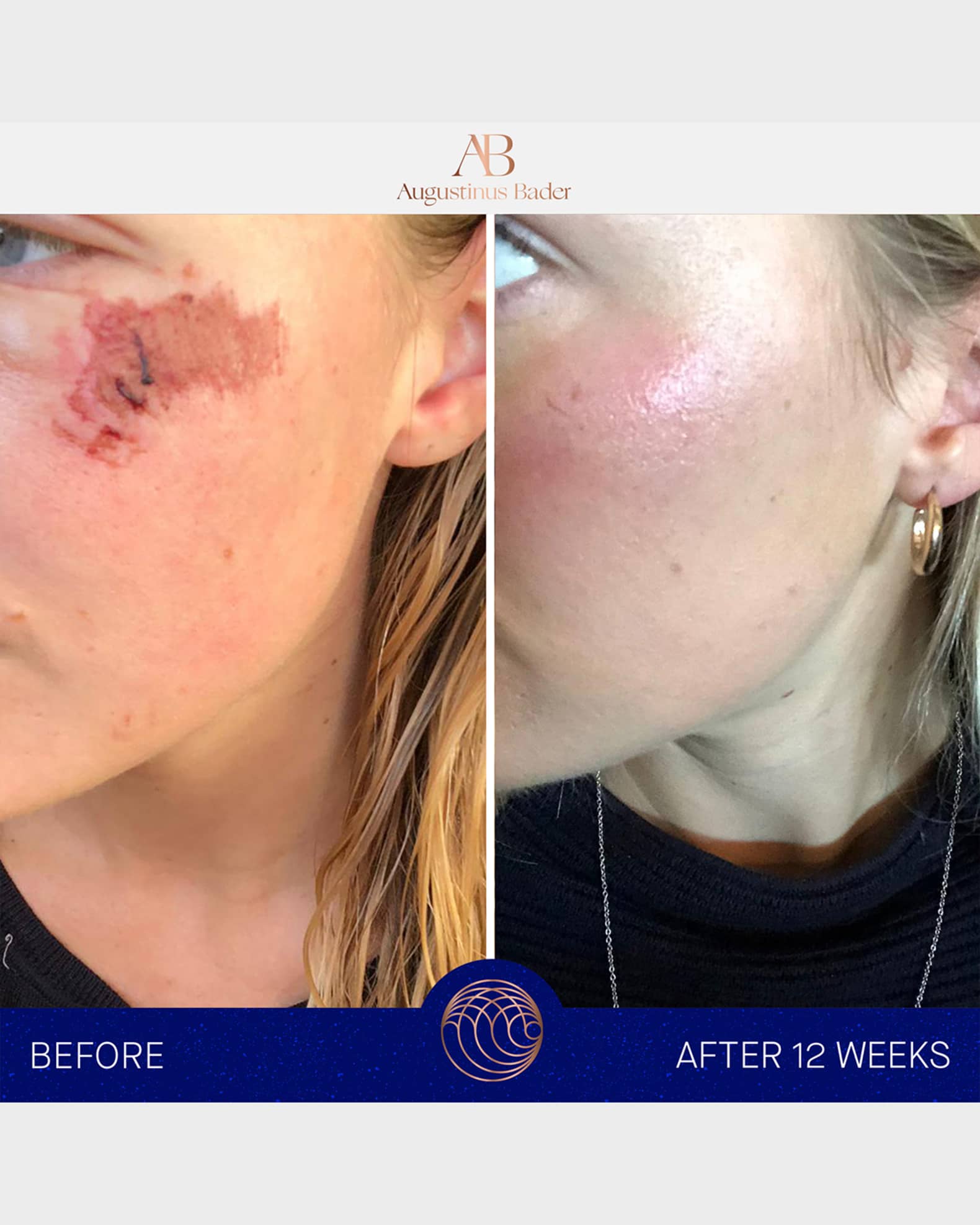 Augustinus Bader The Cream, 1.7 oz./ 50 mL | Neiman Marcus