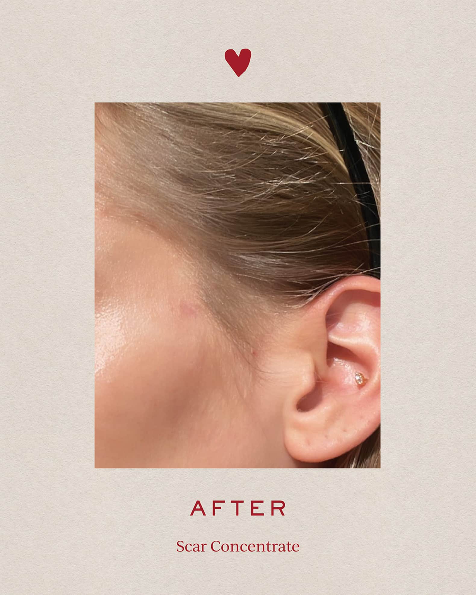 TRONQUE Scar Concentrate, 1 oz. | Neiman Marcus